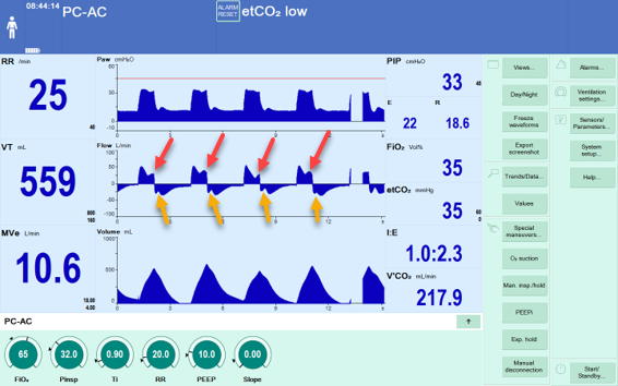 The Toronto Centre Of Excellence In Mechanical Ventilation Reverse