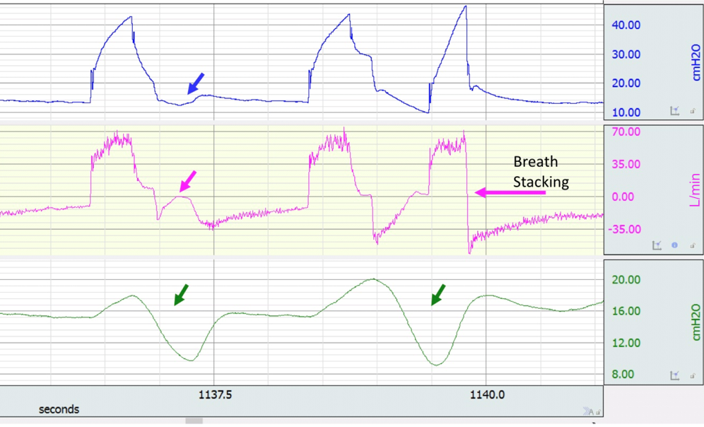 The Toronto Centre Of Excellence In Mechanical Ventilation Reverse